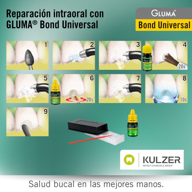 GLUMA Bond Universal | Kulzer México